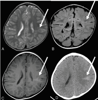 Características radiológicas e patológicas do transmantle sign na ...