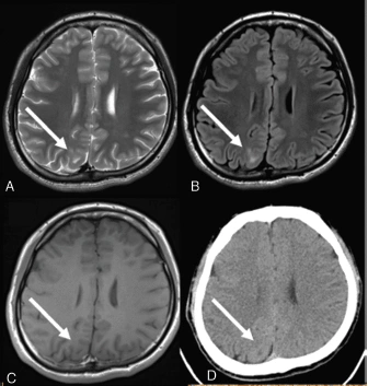 Características radiológicas e patológicas do transmantle sign na ...