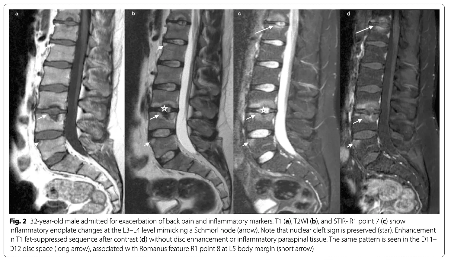 Distúrbios da coluna vertebral que mimetizam infecções – neurosky