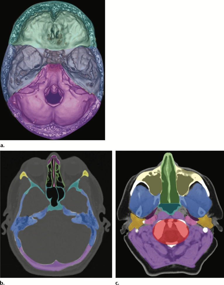 Base Do Cranio Forame Oval Crânio Humano: Forames, Fissuras E