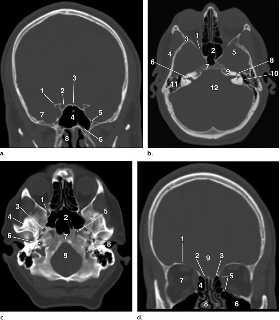 Base Do Cranio Forame Oval Crânio Humano: Forames, Fissuras E