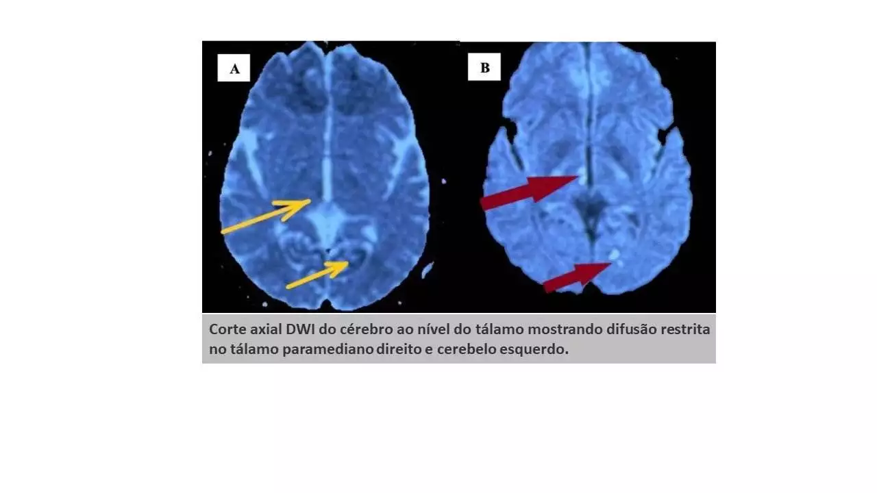 Infarto da Artéria de Percheron: Relato de Caso e Desafio Diagnóstico ...
