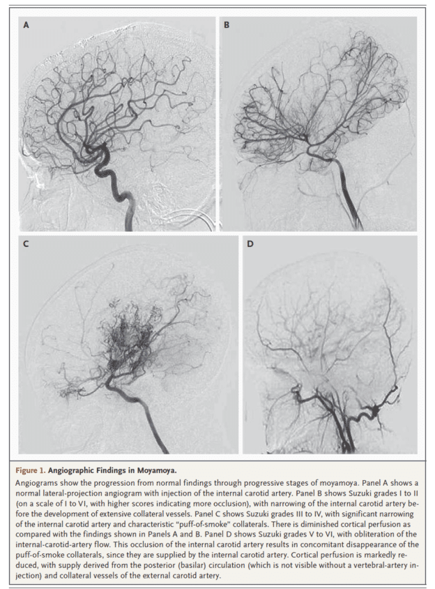 Doença e síndrome de Moyamoya – neurosky