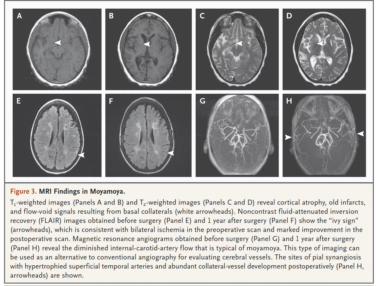 Doença e síndrome de Moyamoya – neurosky