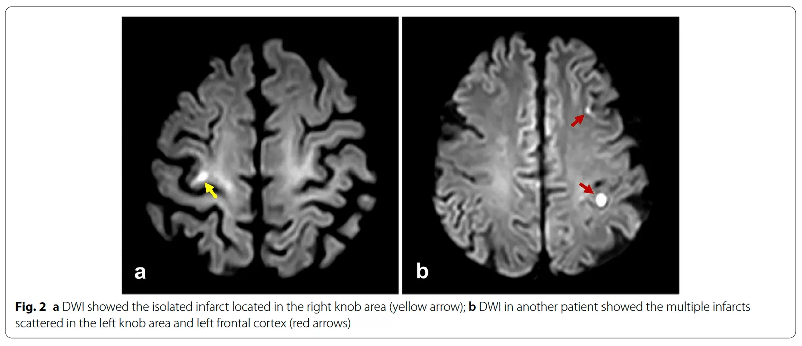 AVC da "Hand Knob area – neurosky