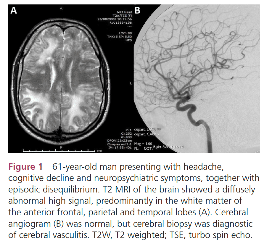 Vasculite Primária do SNC: diagnóstico – neurosky
