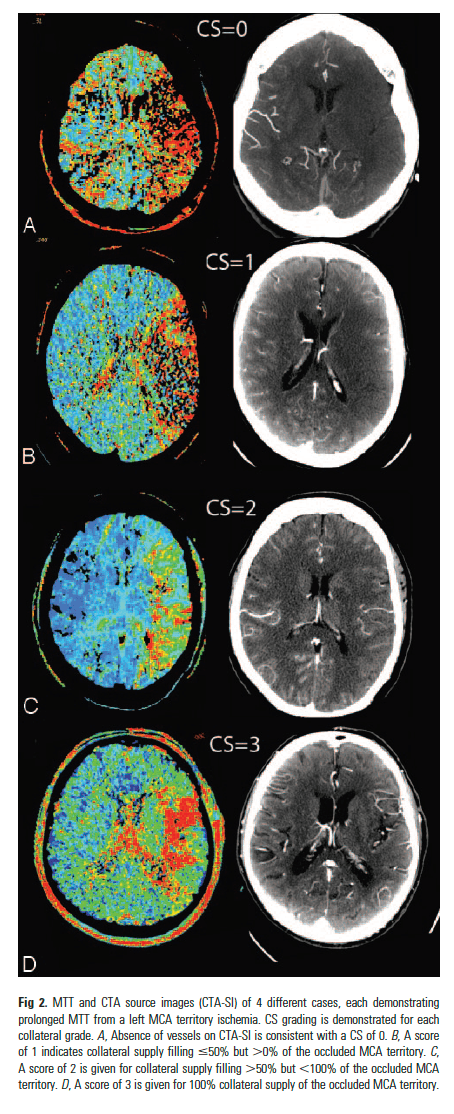Trombectomia Mecânica após 24h – neurosky