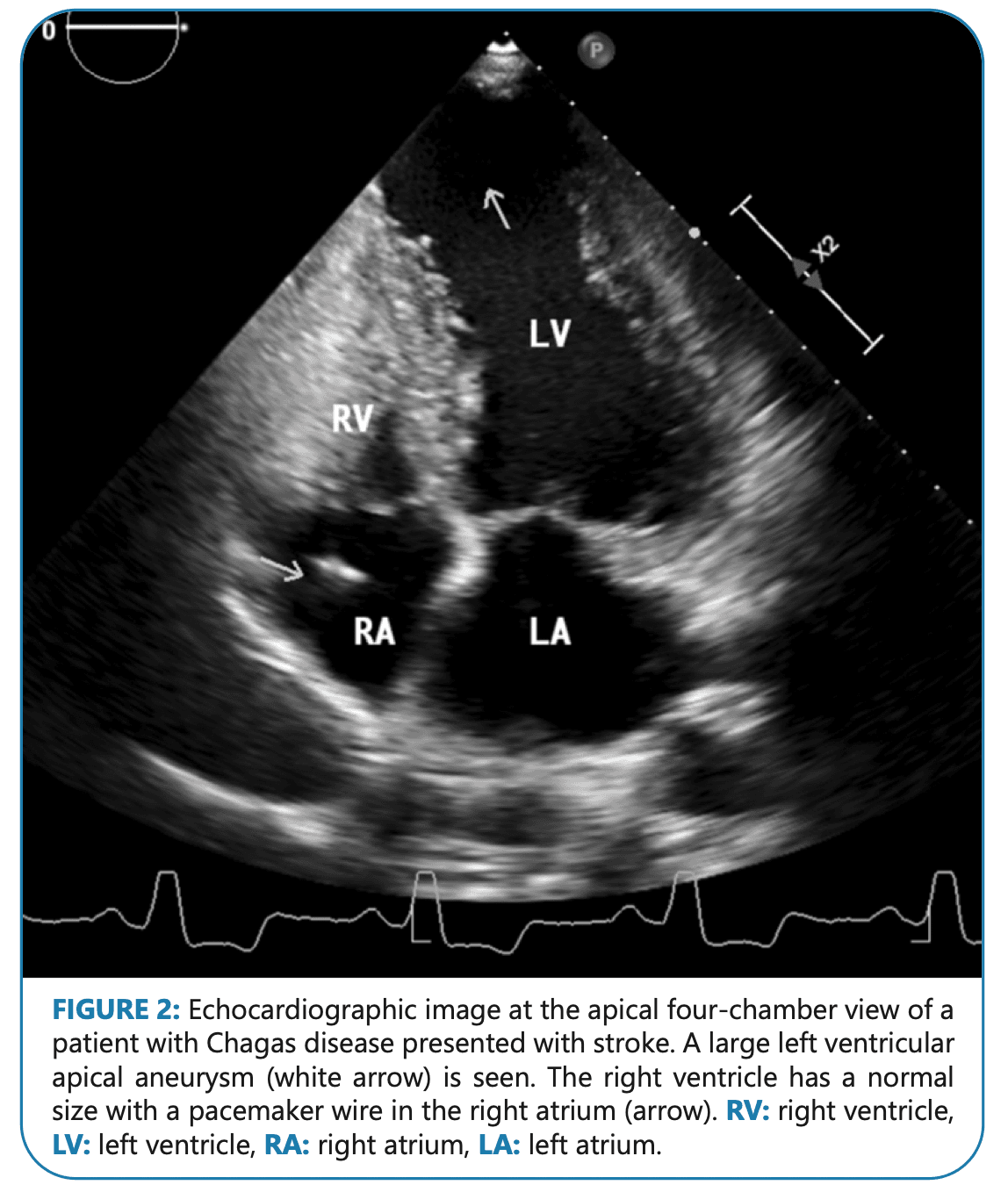 Doença de Chagas e AVCi – neurosky
