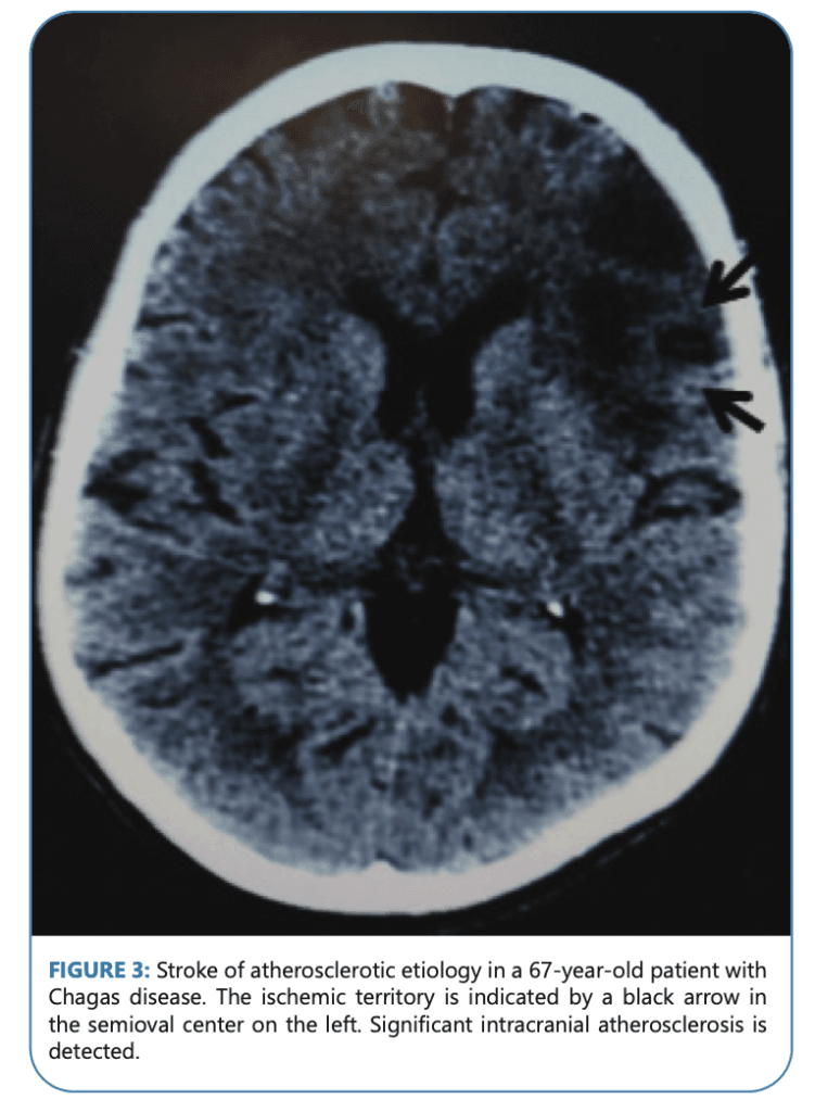 Doença de Chagas e AVCi – neurosky