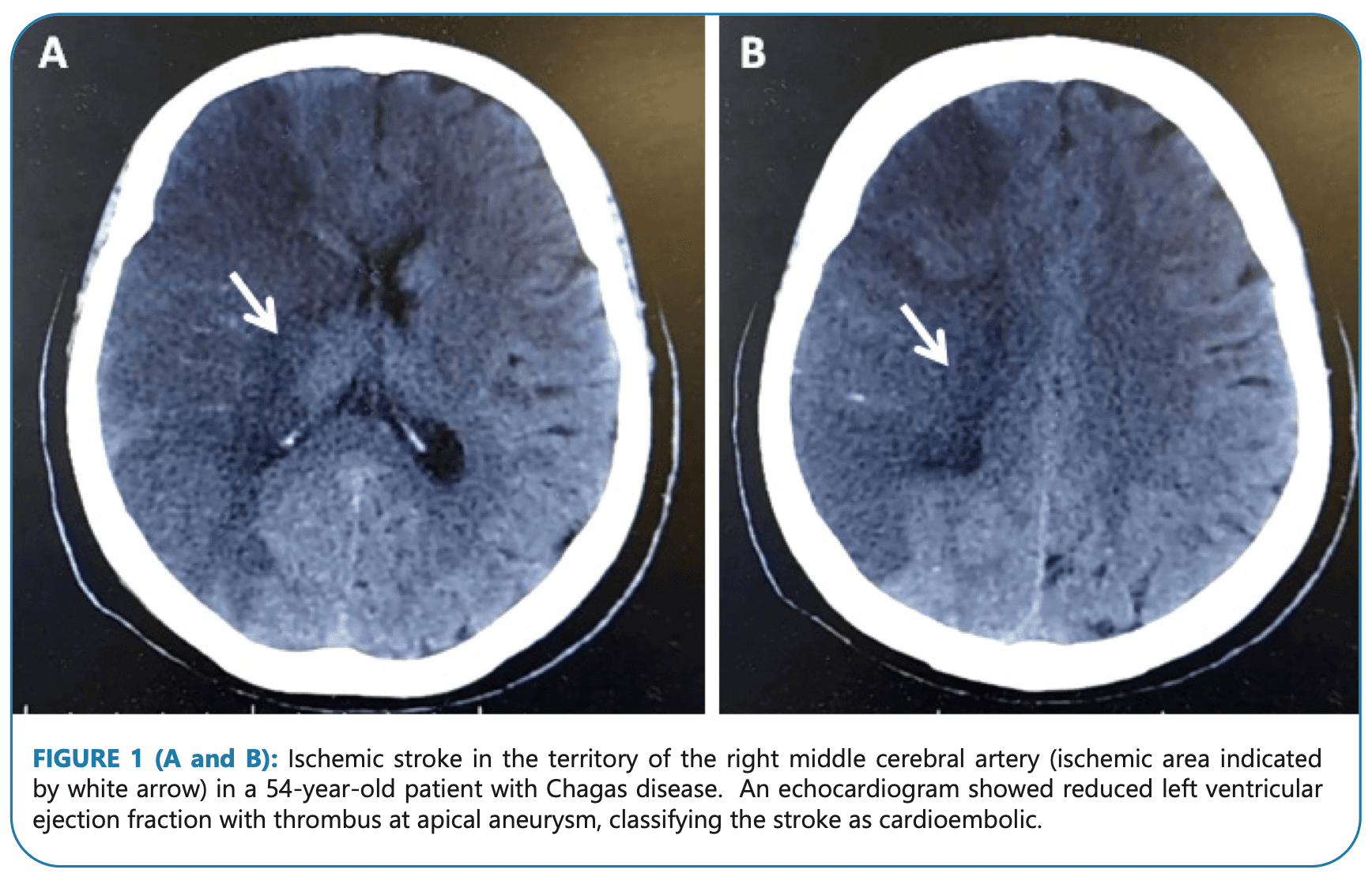 Doença de Chagas e AVCi – neurosky
