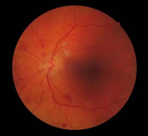 SkySemiology #12 - AVCi e Sintomas Sistêmicos – neurosky