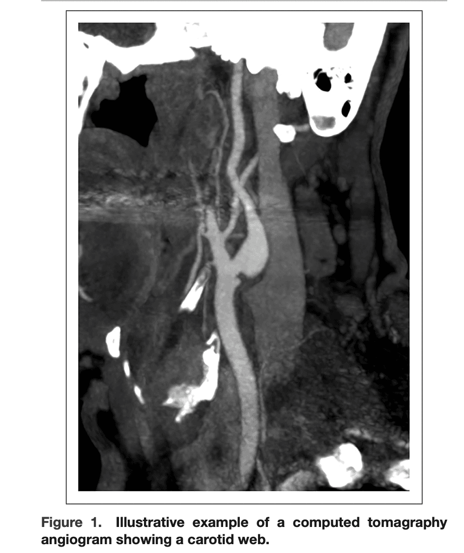 Padrões de AVCi em pacientes com WEB carotídeo – neurosky