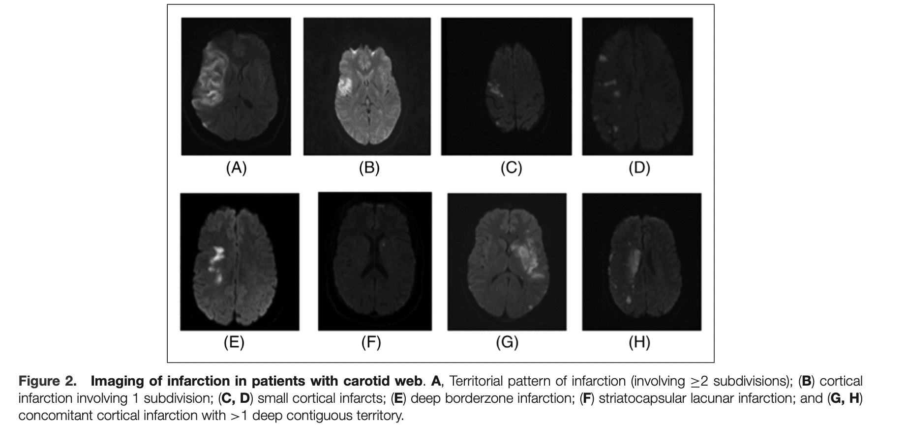 Padrões de AVCi em pacientes com WEB carotídeo – neurosky