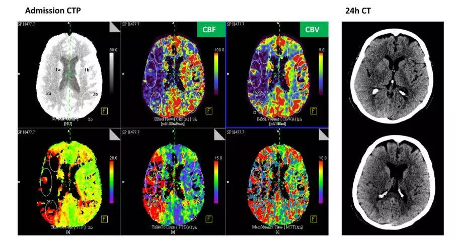 Prevalencia de Ghost core após trombectomia – neurosky