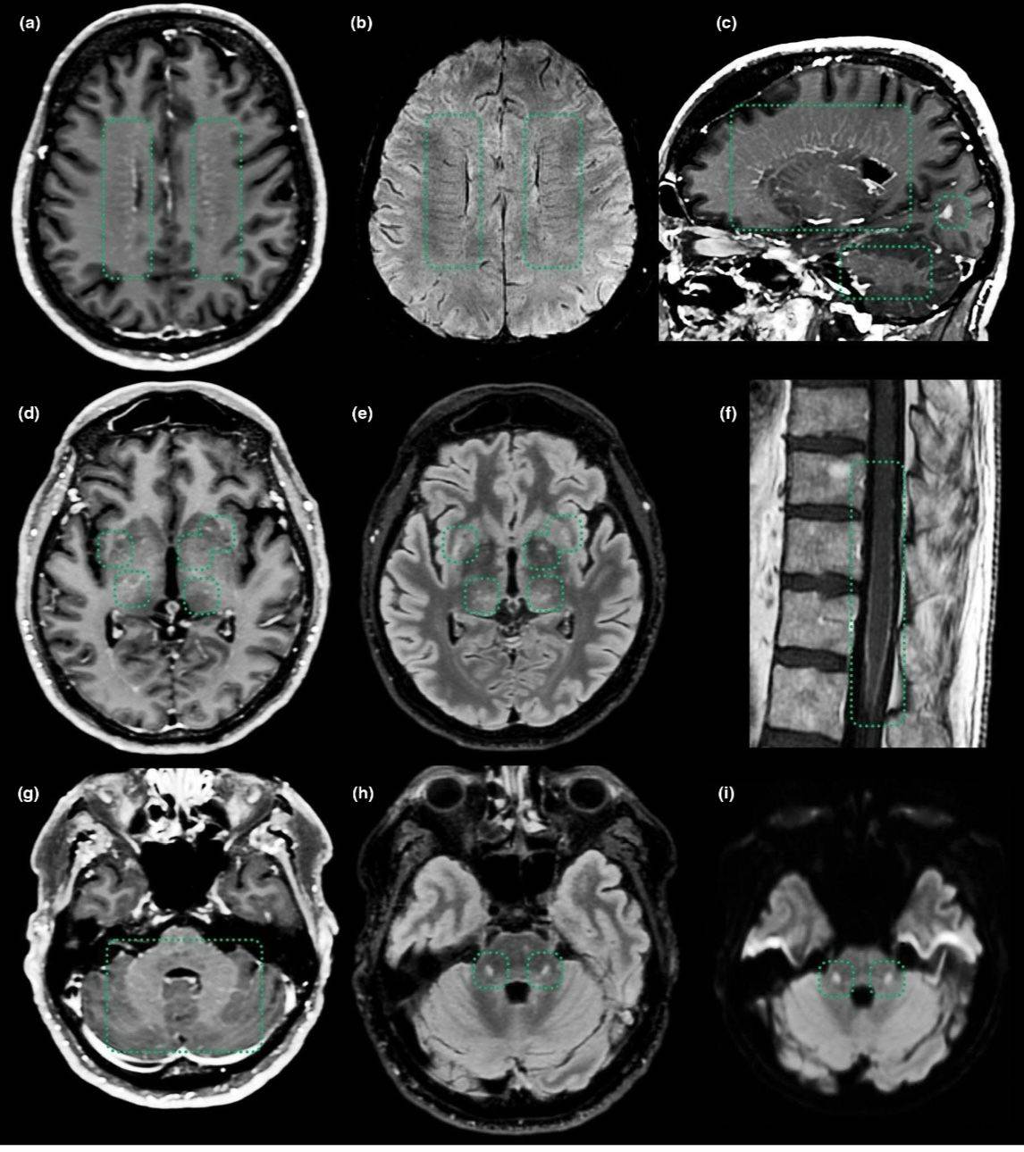 Febre e realce perivascular na RM – neurosky