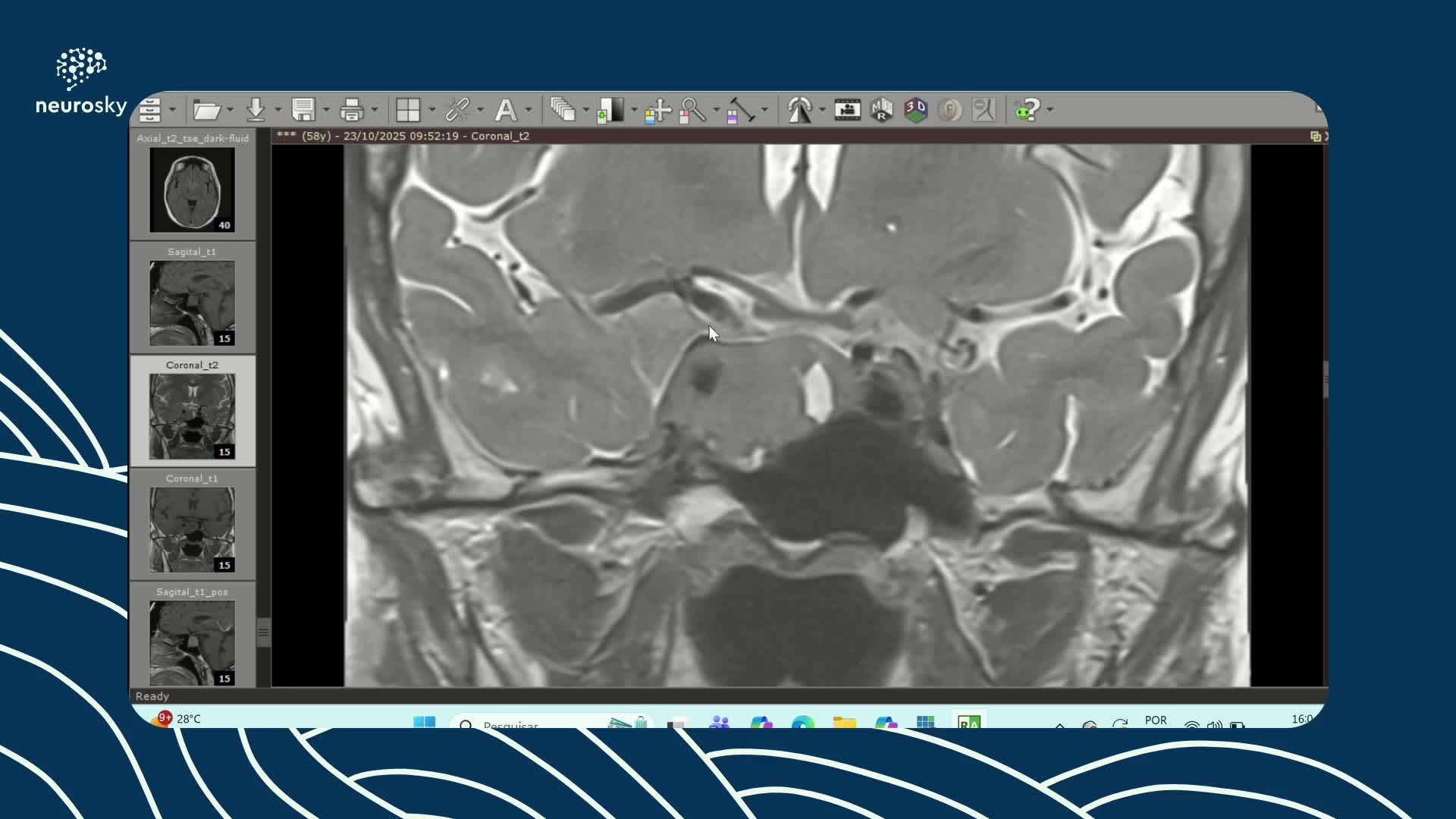 4 Estudos de Caso: Adenomas e Knosp – neurosky